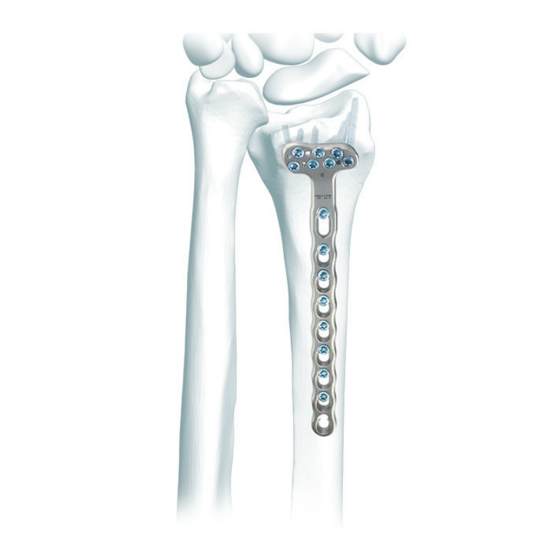 Orthopedic Implants and Instruments Company from China