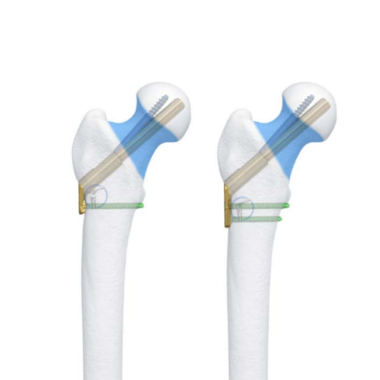 Femoral Neck System FNS - Lyntop Medical
