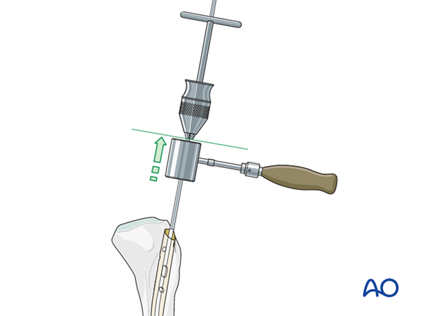 Intramedullary nail removal: key steps, risks and postoperative care ...